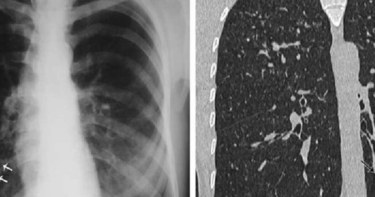 Boala bronșiectazică se poate trata, dar nu și vindeca - ARADON